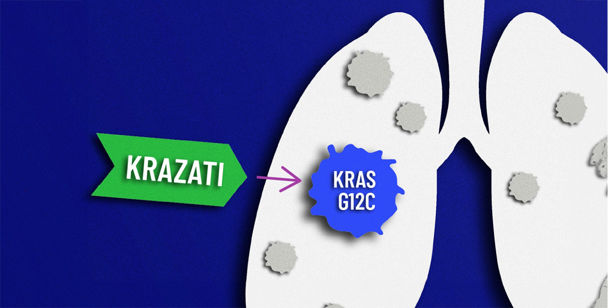 Innovative Cancer Drug Krazati Wins UK Approval for Lung Cancer Treatment